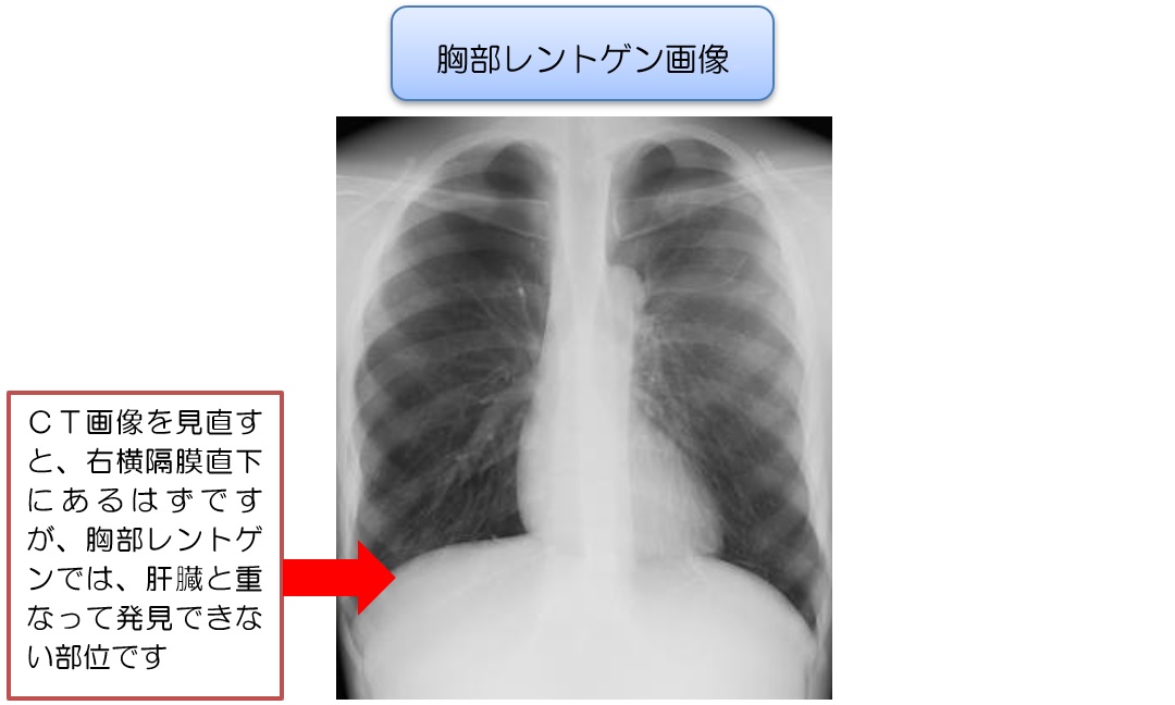 %e8%83%b8%e9%83%a8%e3%83%ac%e3%83%b3%e3%83%88%e3%82%b2%e3%83%b3%e7%94 ...